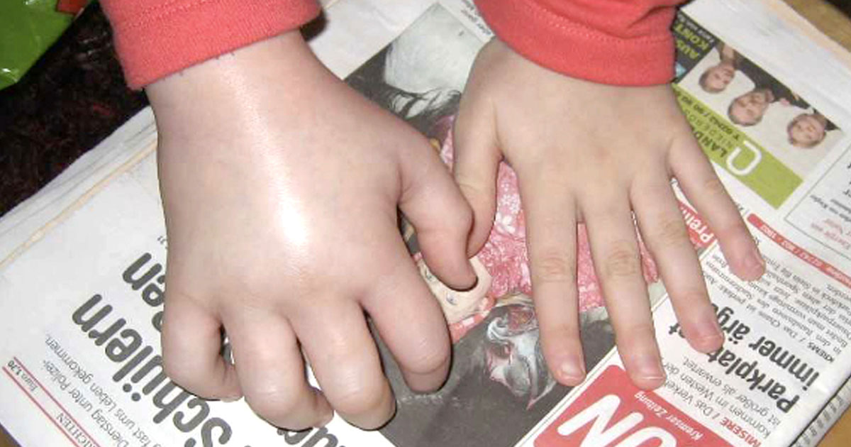 WAO-EAACI-Leitlinie zum hereditären Angioödem | UNIVERSUM INNERE MEDIZIN