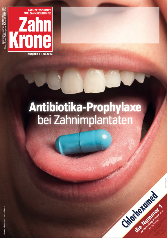 Antibiotika-Prophylaxe bei Zahnimplantaten | Zahn Krone